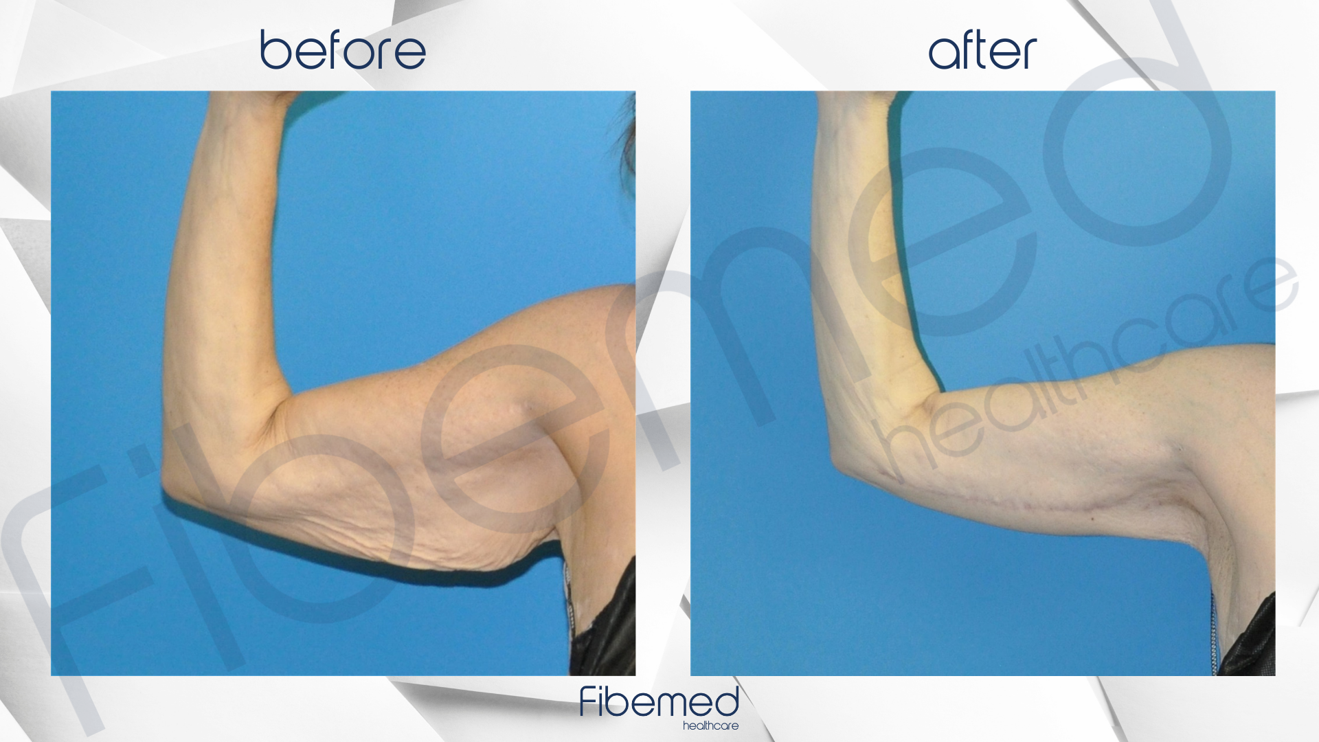 Arm Lift in Turkey | Fibemed Healthcare