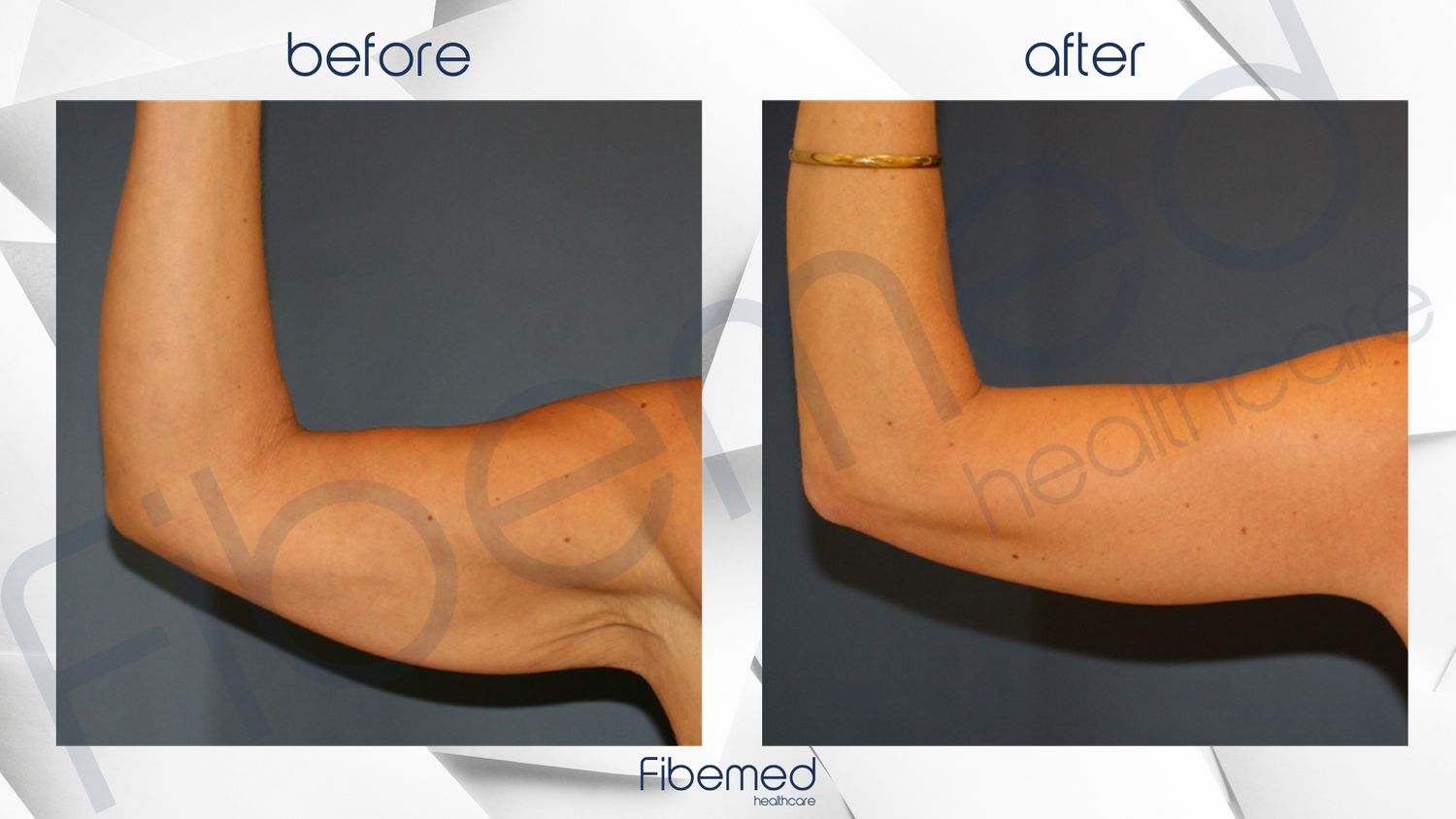 Arm Lift in Turkey | Fibemed Healthcare
