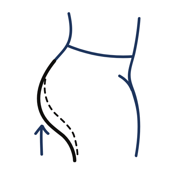 BBL (Brazilian Butt Lift) in Turkey | Fibemed Healthcare