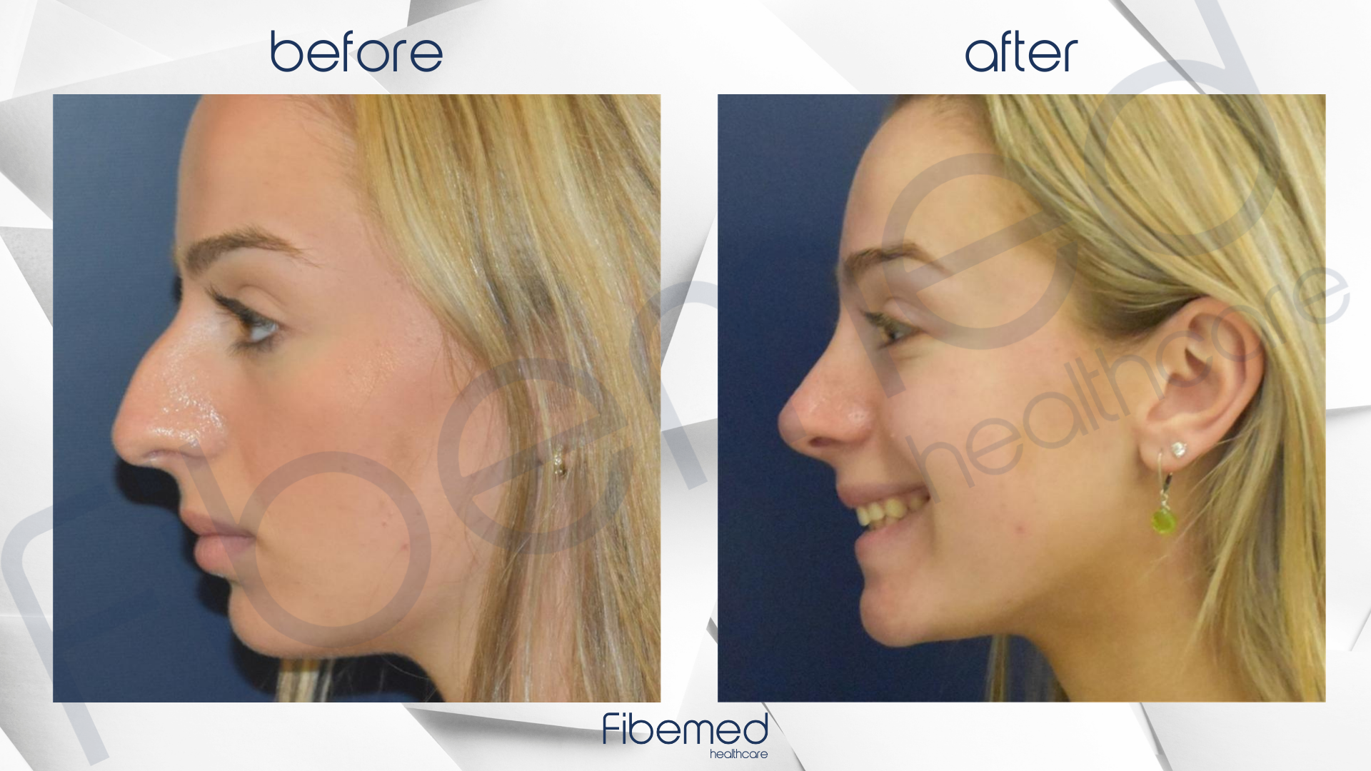 Rhinoplasty in Turkey | Fibemed Healthcare