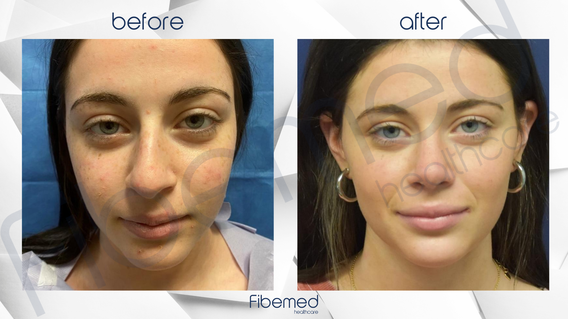 Rhinoplasty in Turkey | Fibemed Healthcare